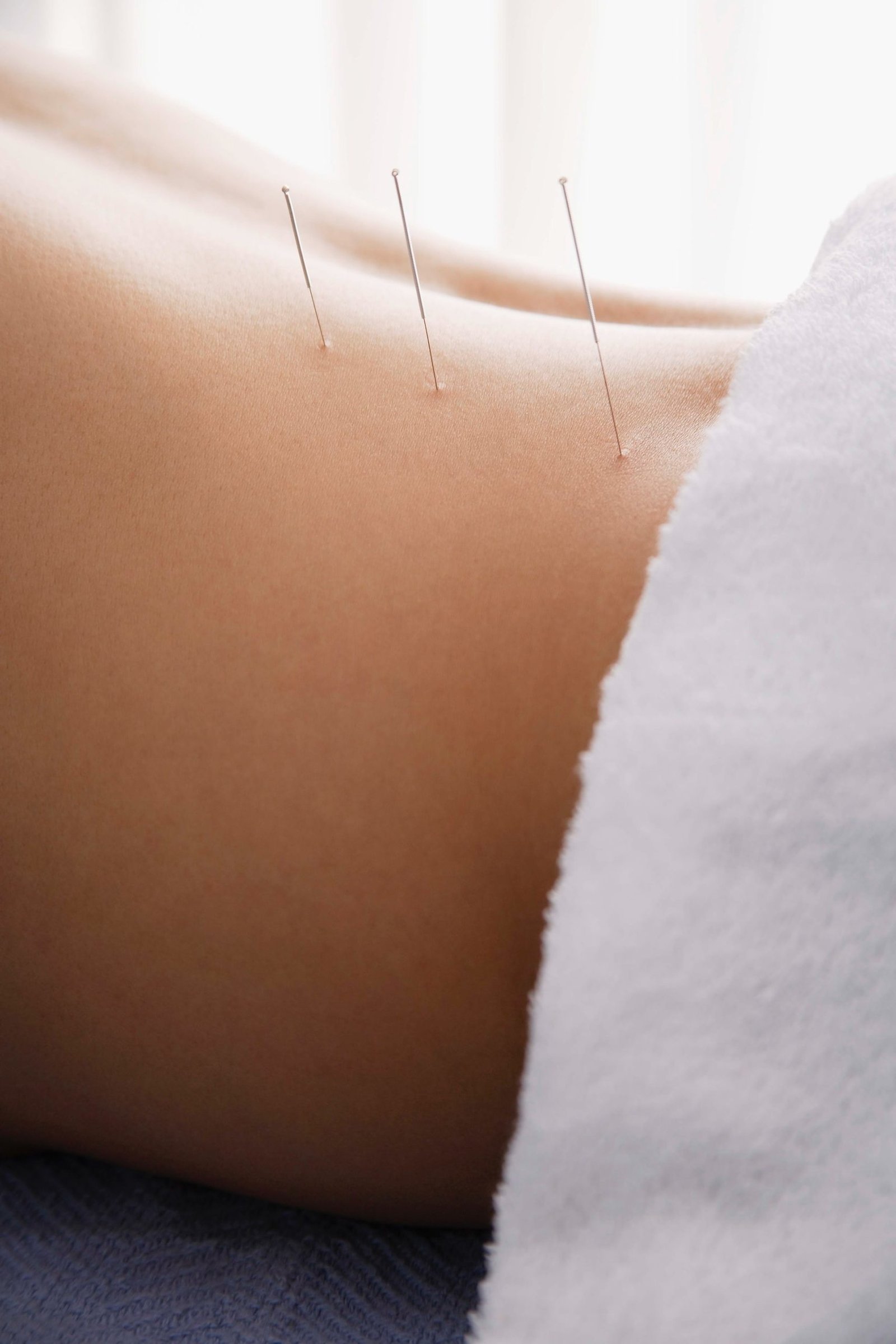 About Acupuncture / TCM - NHS Acupuncture Clinic